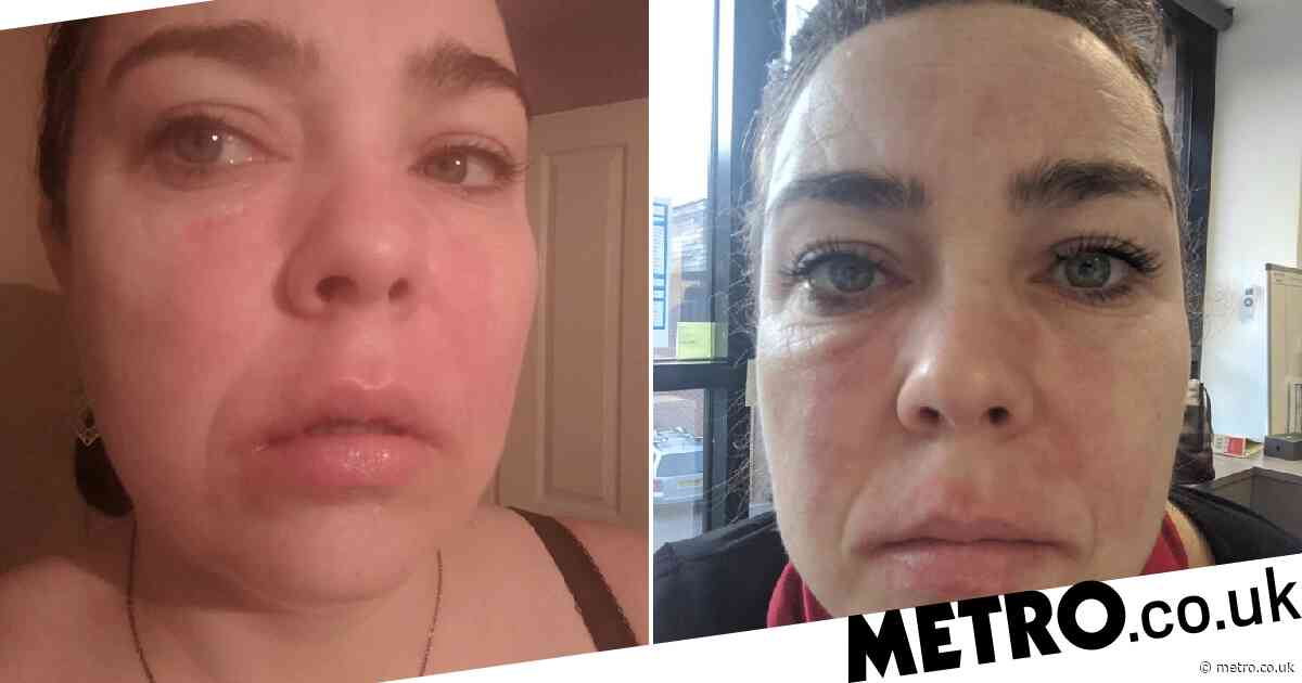 Mum whose confidence was ruined by mystery skin rash is ‘saved’ by £49 ...