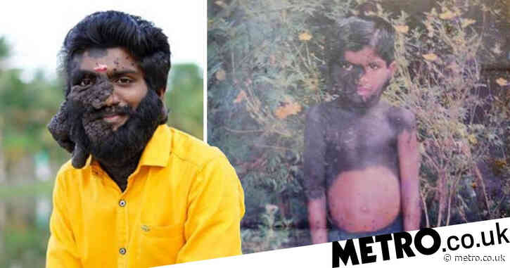 Man born with moles covering 80% of his face reveals how cruel bullies ...