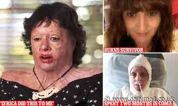 Vicky Edwards claims prescribed painkiller Lyrica caused horrific burns ...